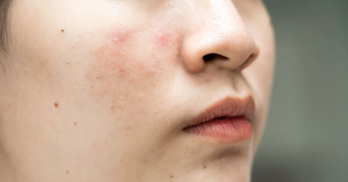How To Get Rid Of Rash On Face Fast | Calm Skin In 48 Hours