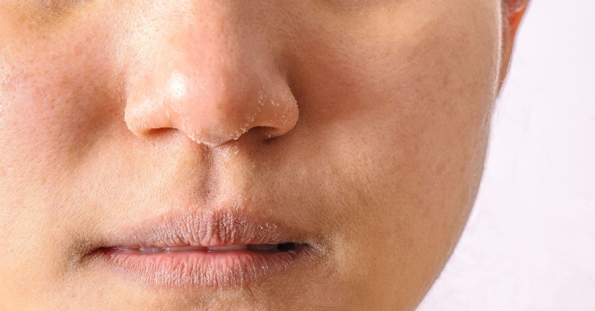 What To Do About Super Dry Skin? | Fix Flakes And Tightness